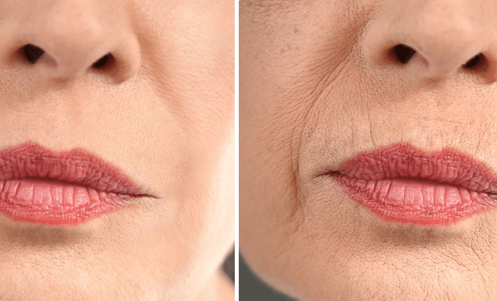 טיפול PRP | CGF | טיפול אנטיאייג'ינג מתקדם באמצעות פלזמה